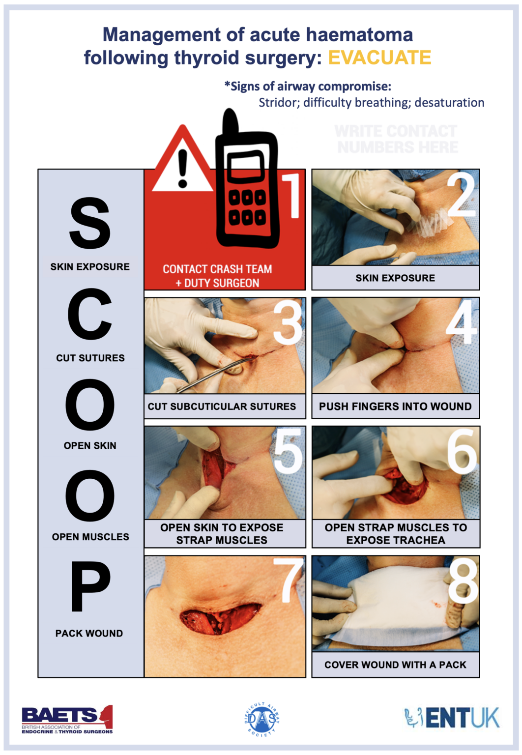Management of haematoma after thyroid surgery guidelines - Difficult ...